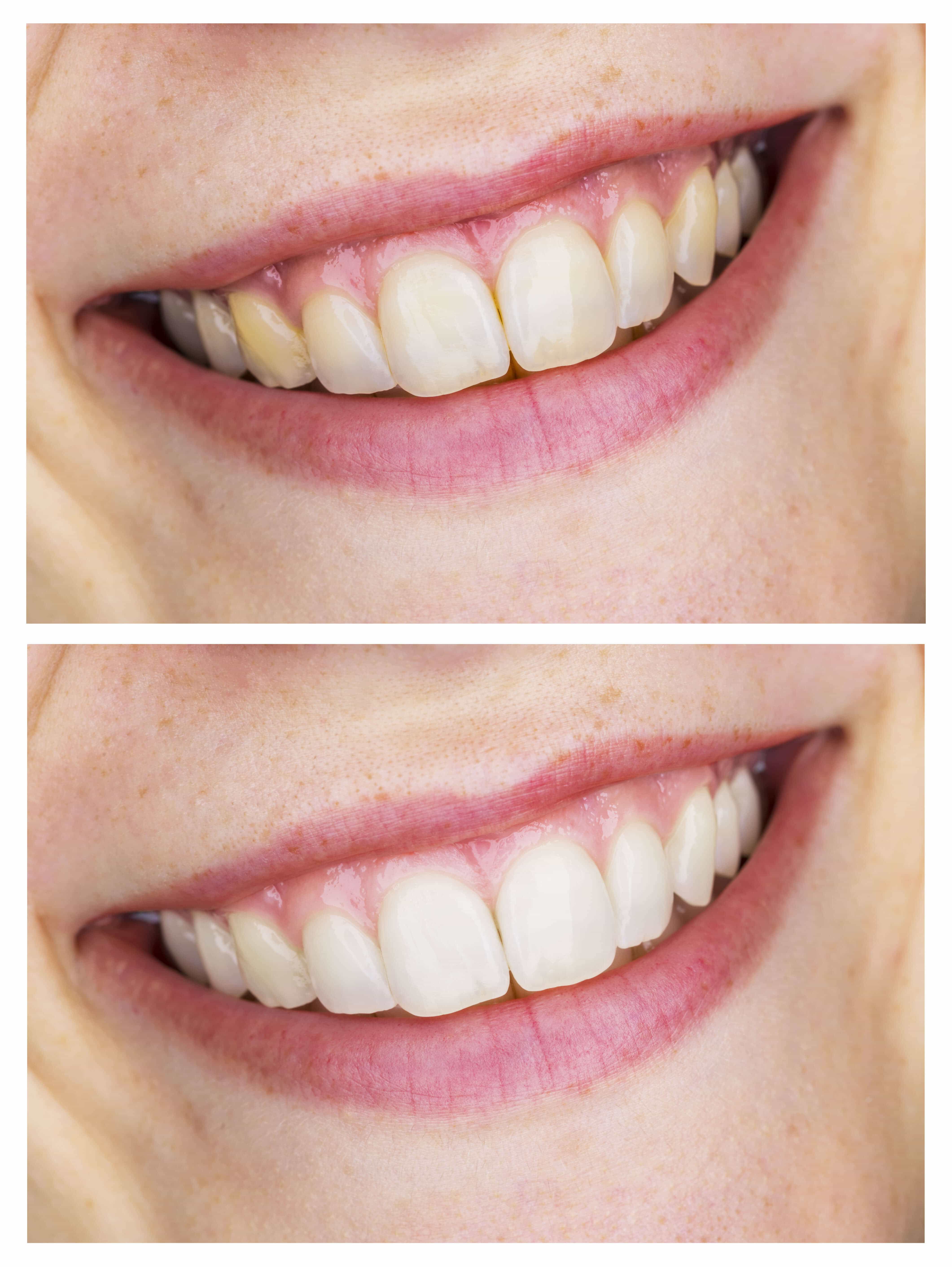 Gestern Kindertag Haltung Zahnbleaching Mit Laser Rhythmus Kost m S dwesten Gestern Kindertag Haltung Zahnbleaching Mit Laser Rhythmus Kost m S dwesten